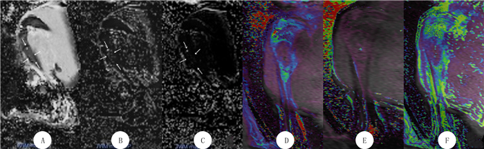 IVIM-DWI及DCE-MRI评估兔VX2恶性骨肿瘤放疗早期疗效的价值