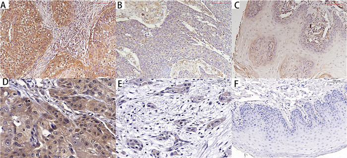 GSDMB在口腔鳞状细胞癌组织中的表达及临床意义